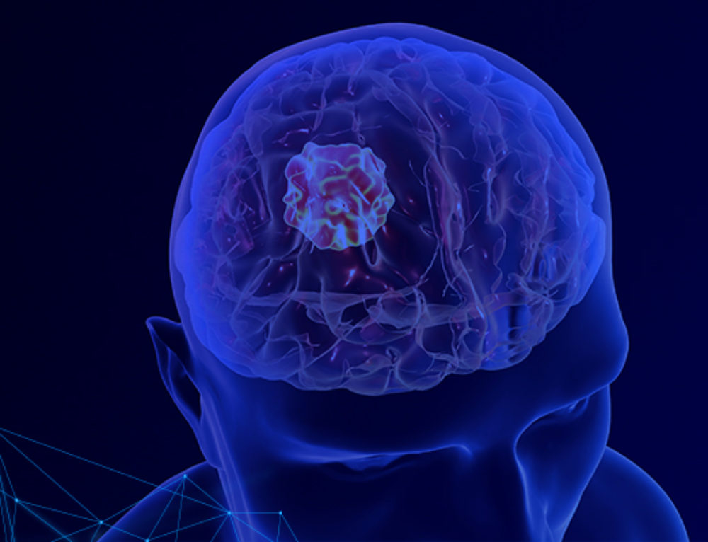 Epilepsia: terapias e cirurgias no combate a crises epilépticas – Dr ...